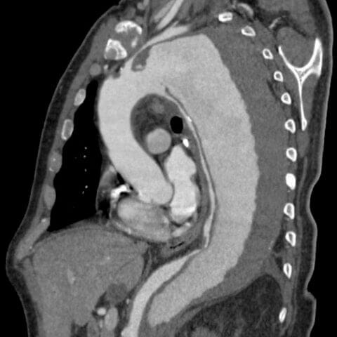 Aortic Dissection Research Funding in the UK & Ireland