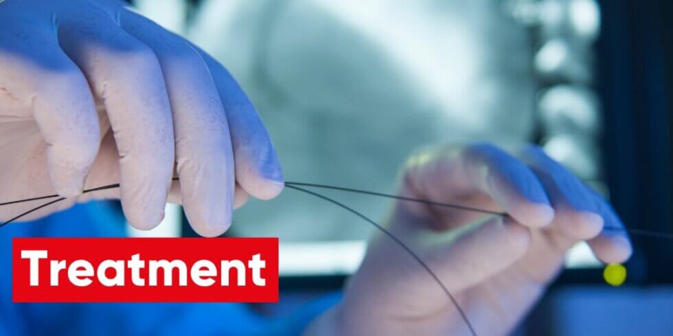 Aortic Dissection Explained Risk Factors, Symptoms, Diagnosis, FAQs