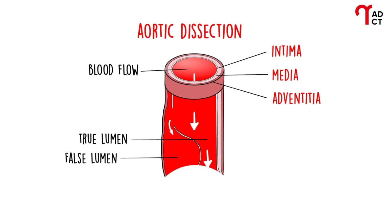 Aortic Dissection Explained Risk Factors, Symptoms, Diagnosis, FAQs