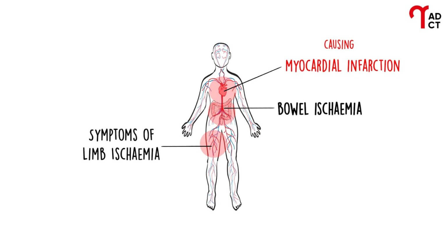 Aortic Dissection Explained Risk Factors, Symptoms, Diagnosis, FAQs