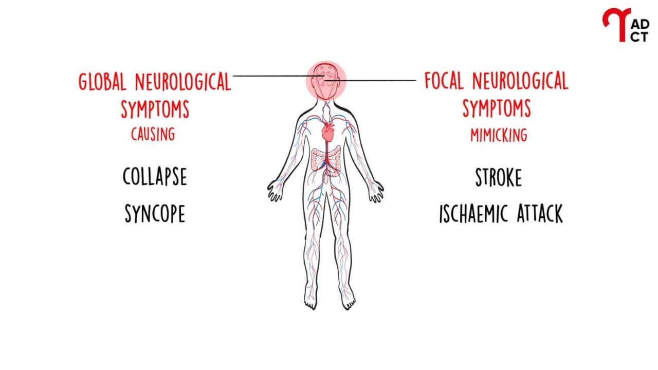 Aortic Dissection Explained Risk Factors, Symptoms, Diagnosis, FAQs